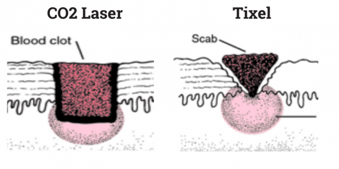 Tixel | London | Rejuvenation, lines, acne scars, eyes | Leading doctors