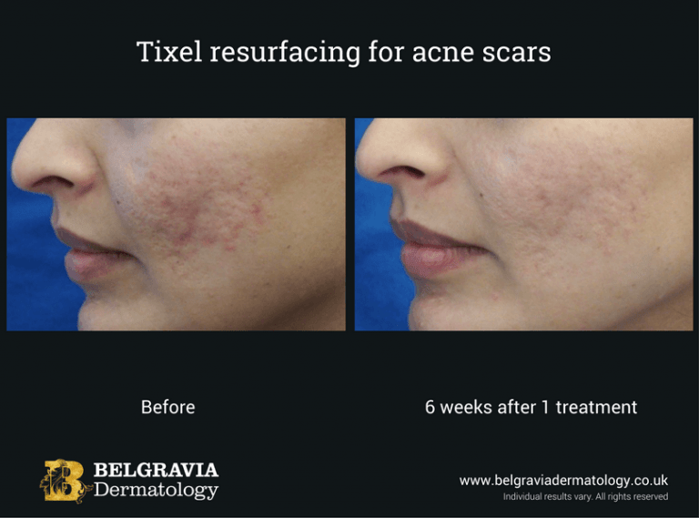 Tixel | London | Rejuvenation, lines, acne scars, eyes | Leading doctors