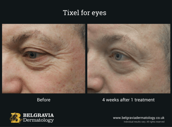 Tixel | London | Rejuvenation, lines, acne scars, eyes | Leading doctors