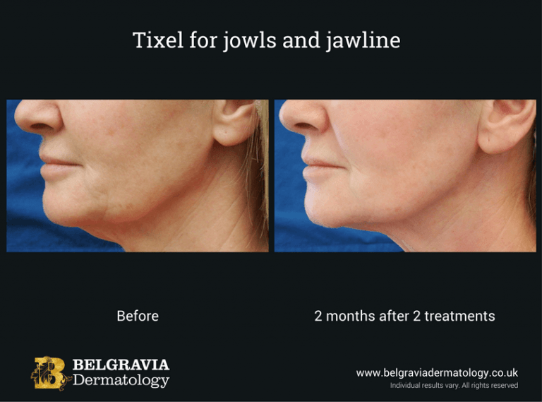Tixel | London | Rejuvenation, lines, acne scars, eyes | Leading doctors