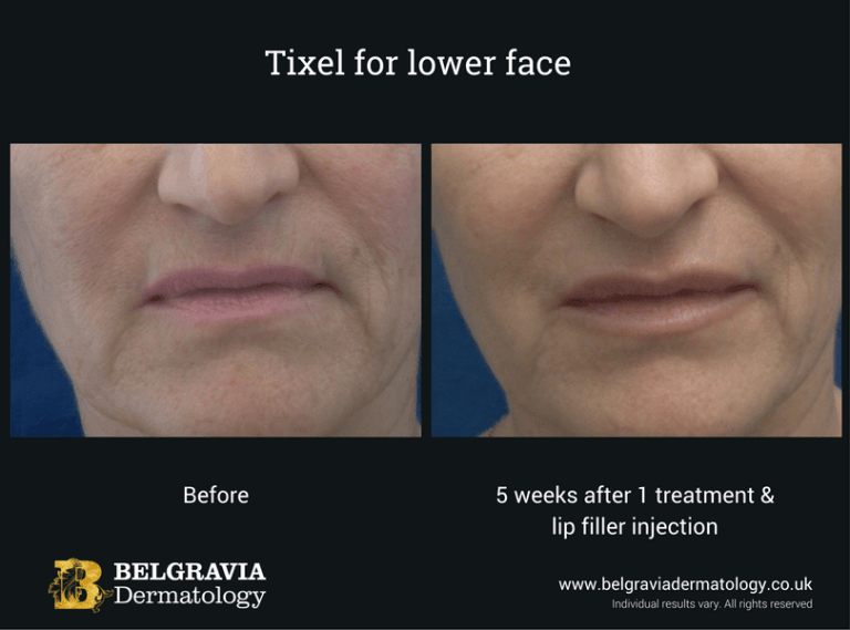 Tixel | London | Rejuvenation, lines, acne scars, eyes | Leading doctors