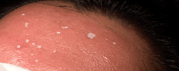 TCA Cross for acne scars | Belgravia Dermatology