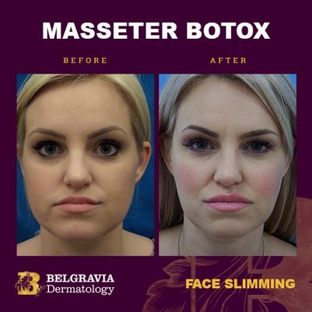 Botox for masseter muscles in London for face slimming and teeth grinding