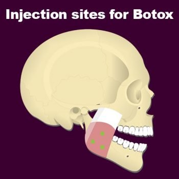 Botox for masseter muscles in London for face slimming and teeth grinding