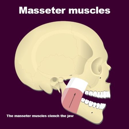 Botox for masseter muscles in London for face slimming and teeth grinding