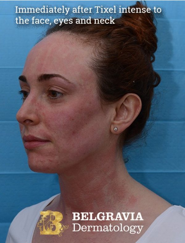 Tixel | London | Rejuvenation, lines, acne scars, eyes | Leading doctors